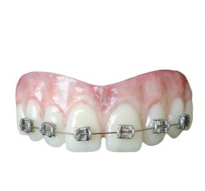 Lemmy ProFX Teeth With Silver Braces - Horror Shop FX